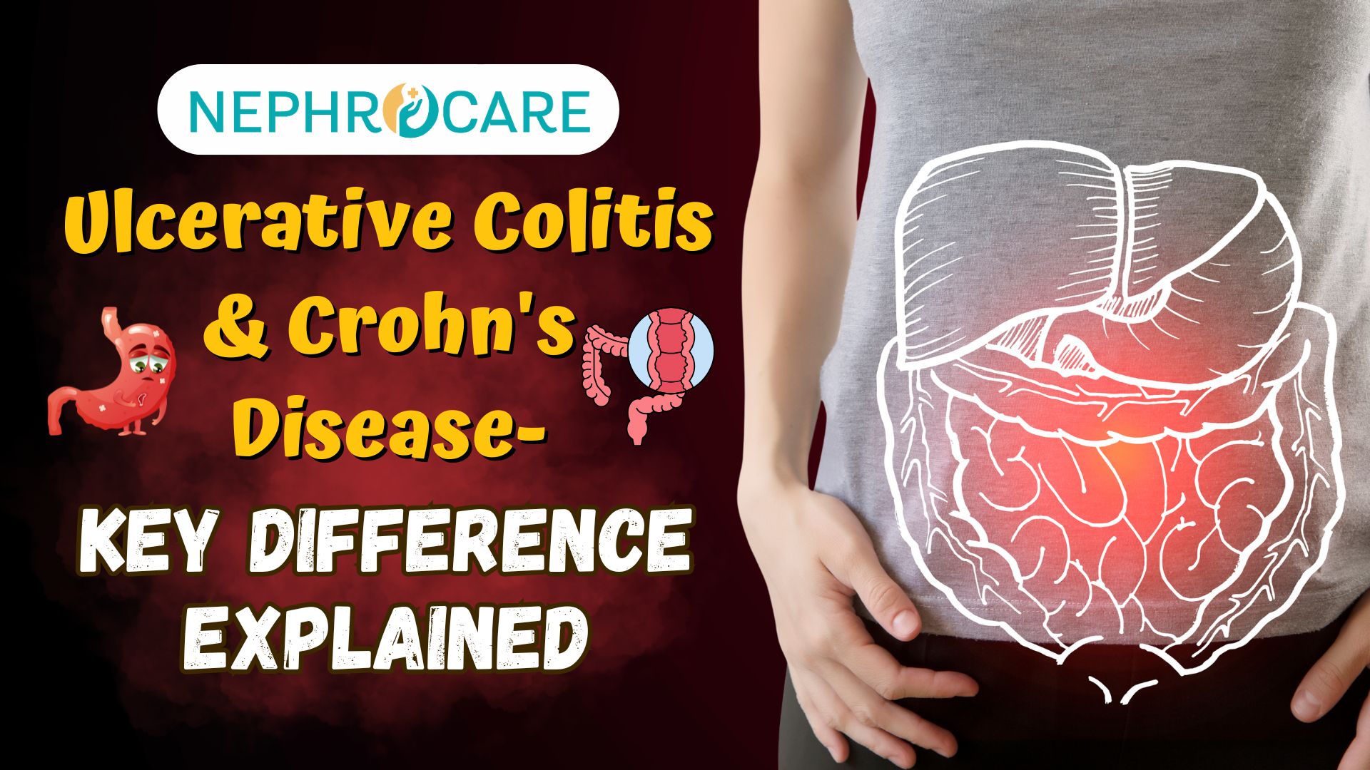 Ulcerative Colitis and Crohn’s Disease – Key Differences Explained